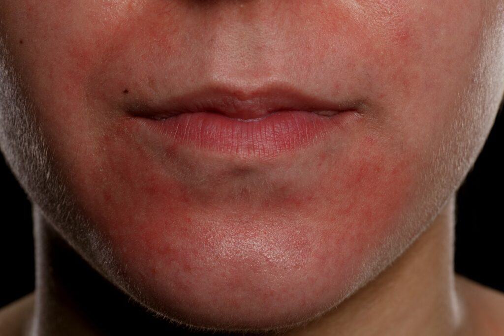 Want To Know Why Your Face Turns Red want-to-know-why-your-face-turns-red
