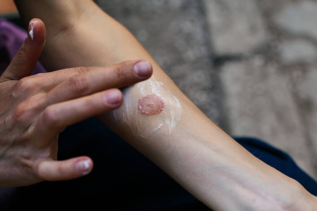 What is Ringworm ? - Its causes ,symptoms and treatment.