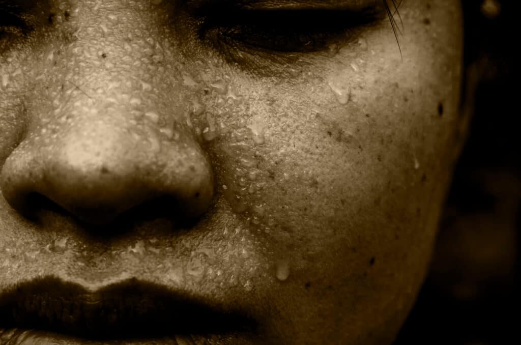 Why Does My Child Sweat So Much | Harley Street Dermatology Clinic
